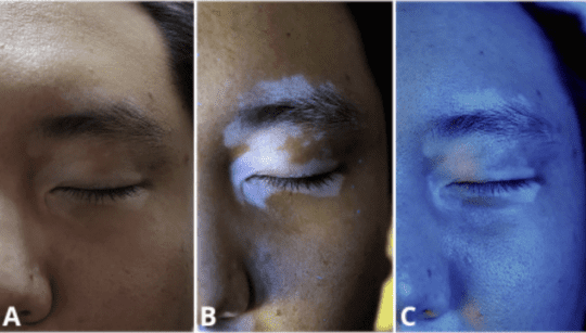 VITILIGO: DIAGNOSIS AND TREATMENT PROGRAM - CubaHeal