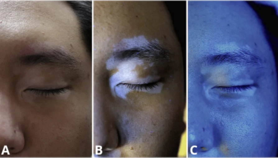 Vitiligo Focal Pathology Outlines Vitiligo