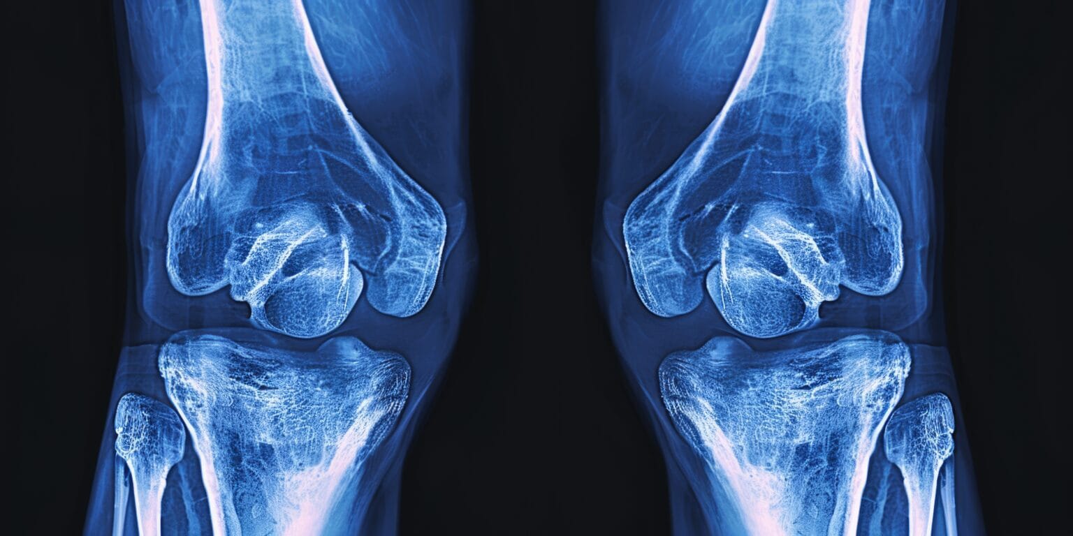 Medial Collateral Ligament (MCL) Injury - CubaHeal